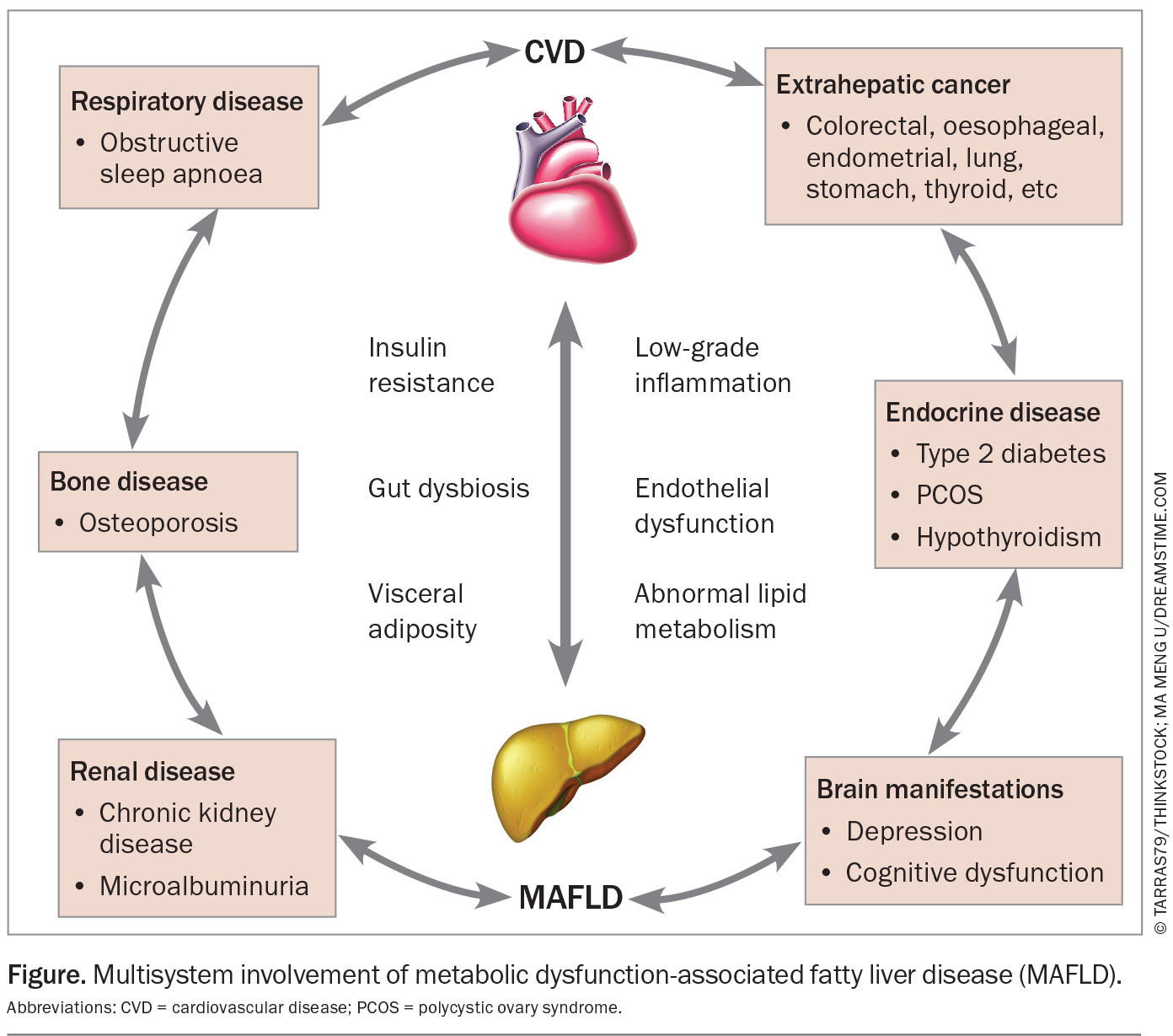 Metabolic dysfunction-associated fatty liver disease: the crucial link to CVD | Medicine Today