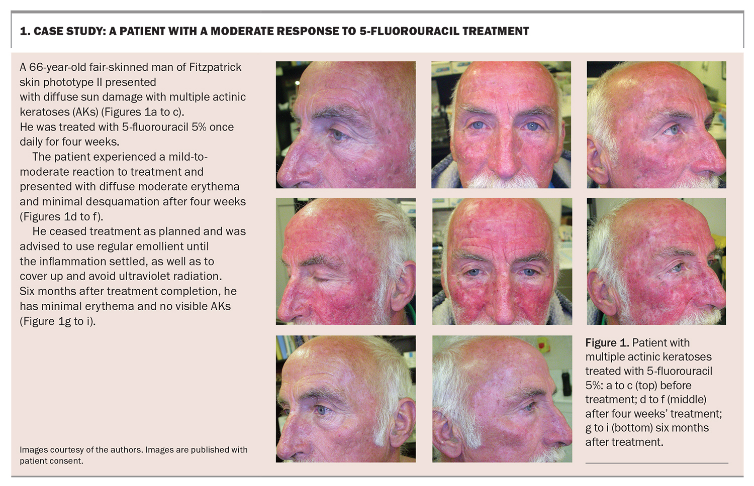 Mild Actinic Keratosis Mild Actinic Keratosis