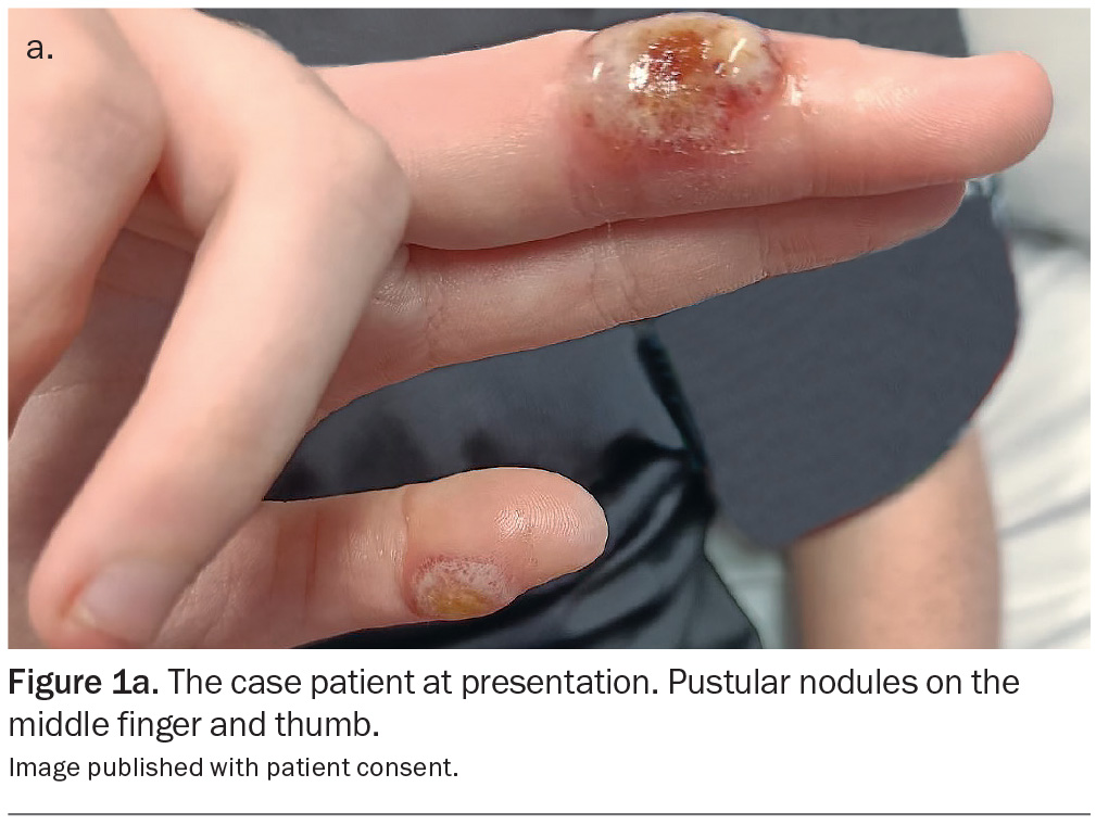 A young woman with pustular finger nodules of acute onset | Medicine Today