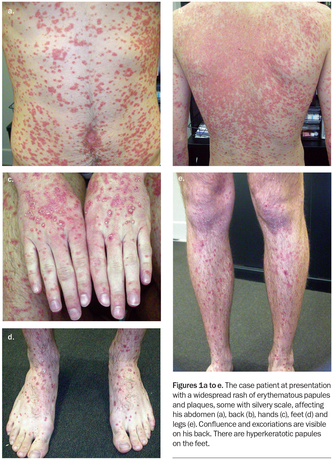 Erythematous Papular Rash Erythematous Papular Rash