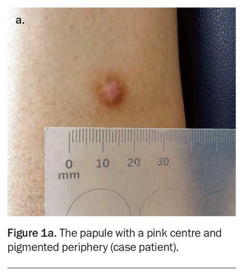 A man with a painless papule on the leg | Medicine Today