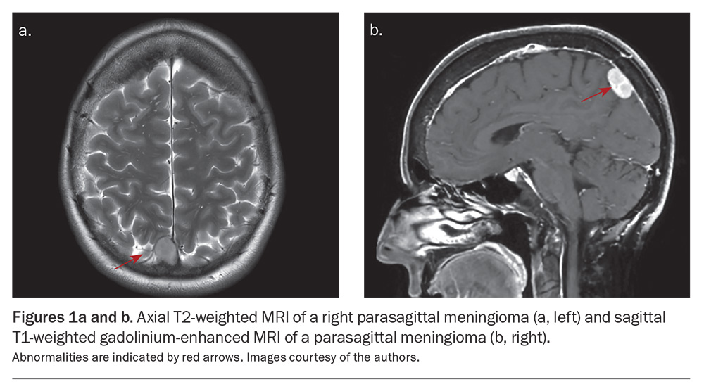 Cranial neuroimaging: incidental findings and their significance ...
