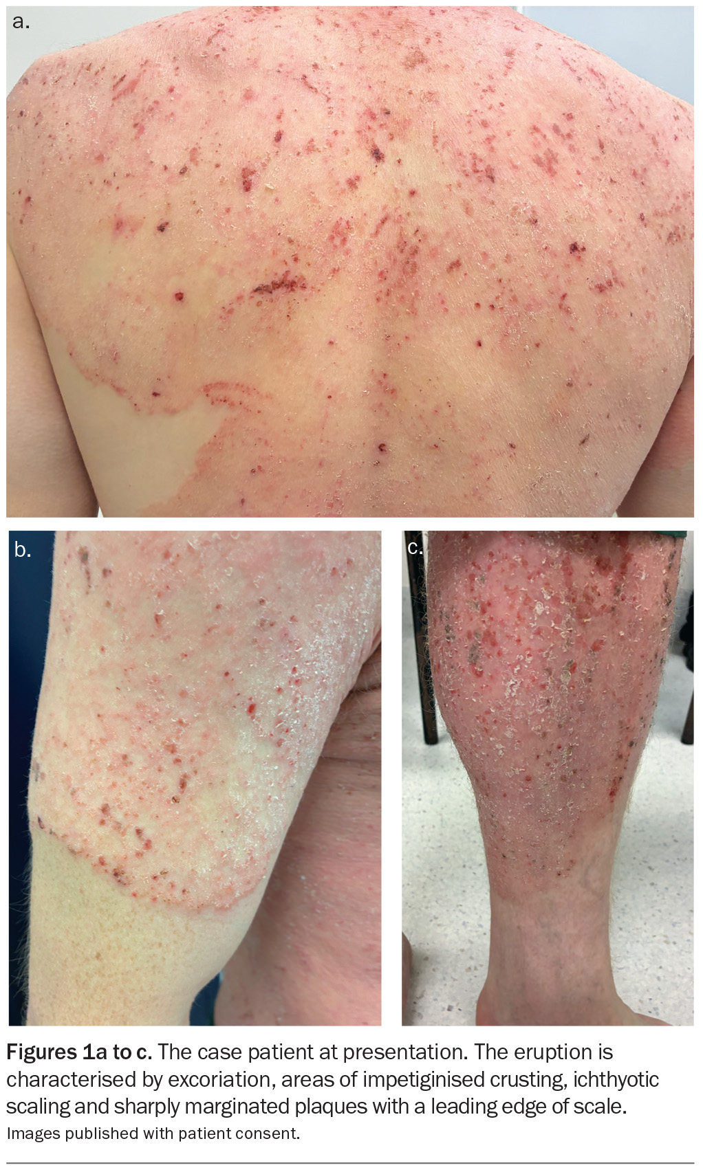 A man with a widespread pruritic skin eruption | Medicine Today