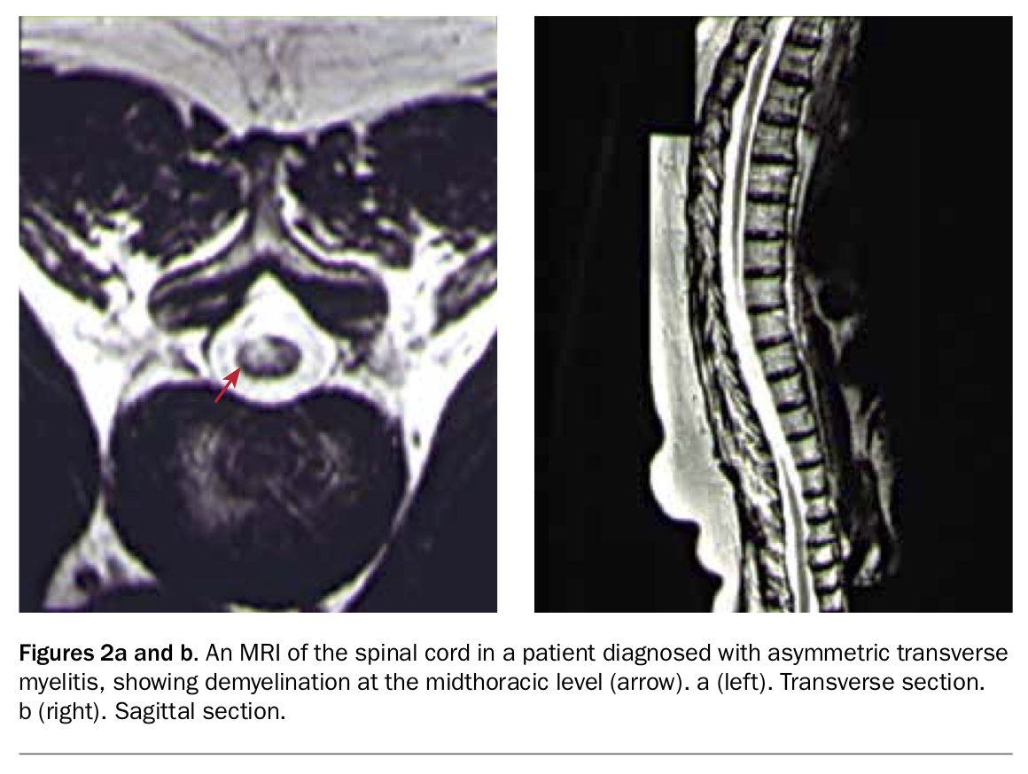 Finding the cause of sudden leg weakness | Medicine Today