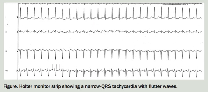 Atrial flutter in a 65-year-old woman with asthma | Cardiology Today