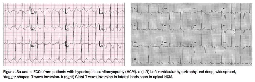 Hypertrophic cardiomyopathy. Keys to minimising morbidity and mortality ...