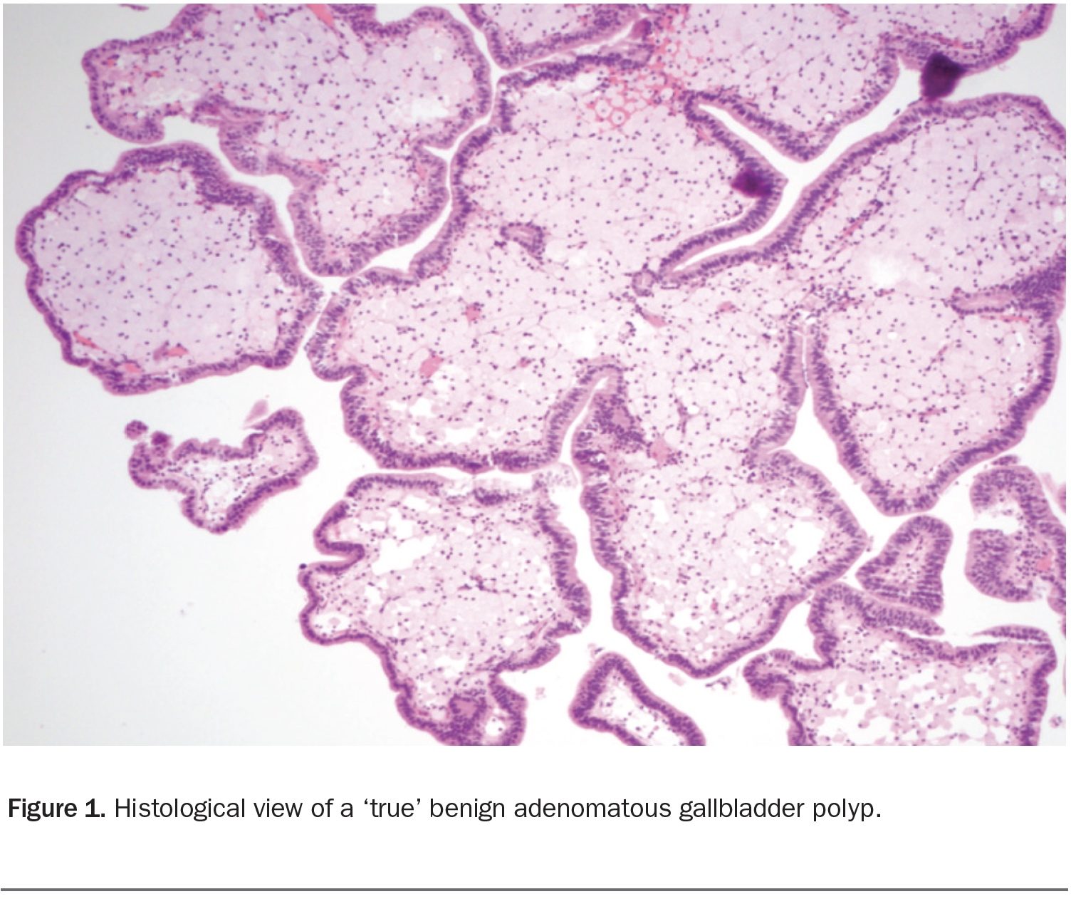 Gallbladder polyps. To treat or not to treat? | Medicine Today