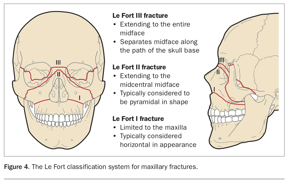 Maxillary Fracture