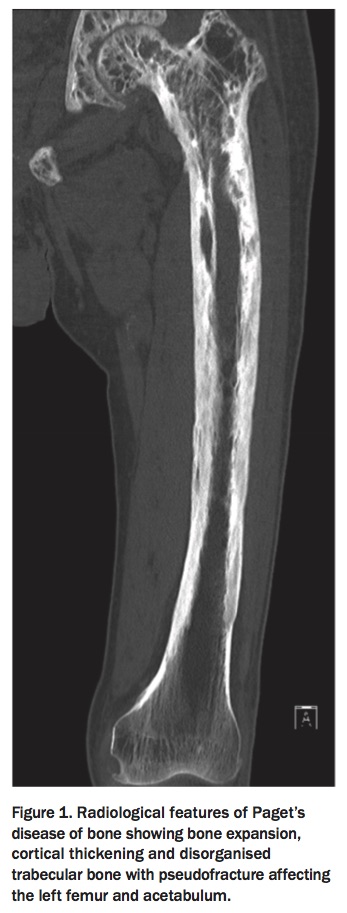 Paget’s disease of bone: who to treat and why it matters ...