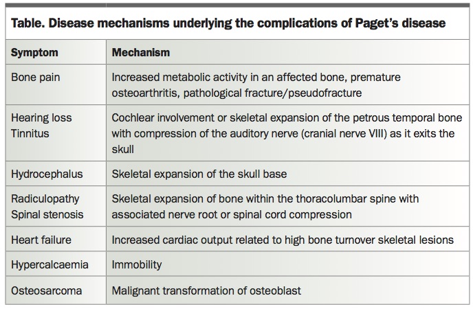 Paget’s disease of bone: who to treat and why it matters ...