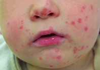 A 6-month-old boy with a vesicular rash | Medicine Today