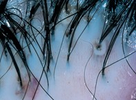 tufted folliculitis icd 10