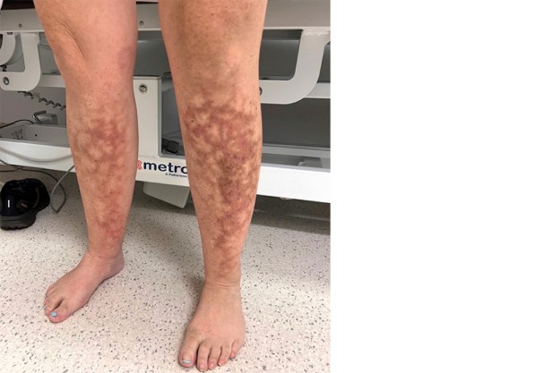 hyperpigmentation on legs