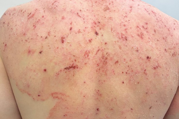 A man with a widespread pruritic skin eruption | Medicine Today