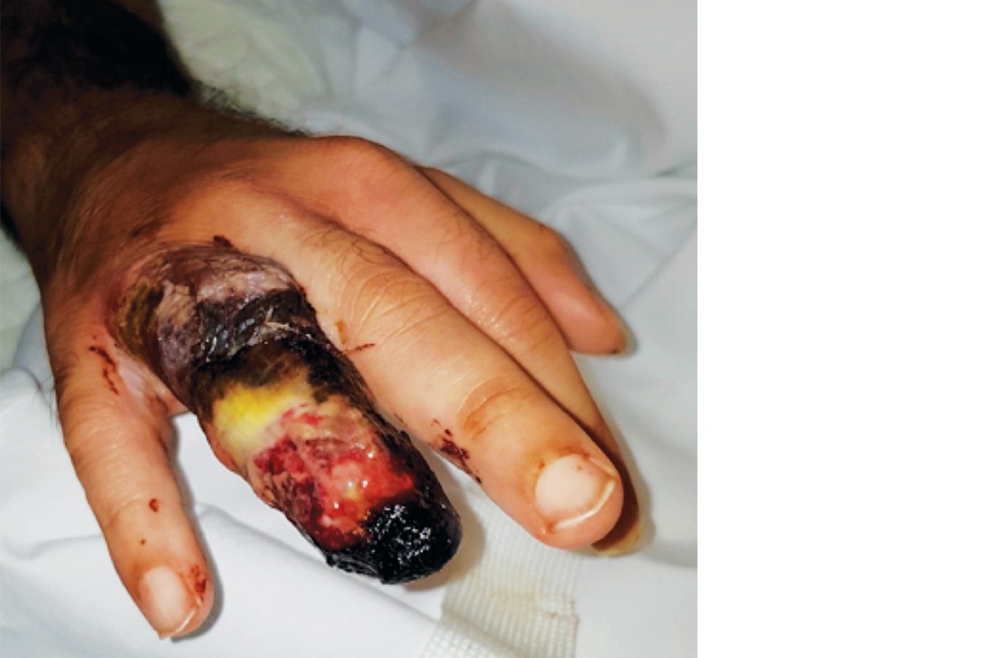 Painful ulceration with necrosis on a finger | Medicine Today