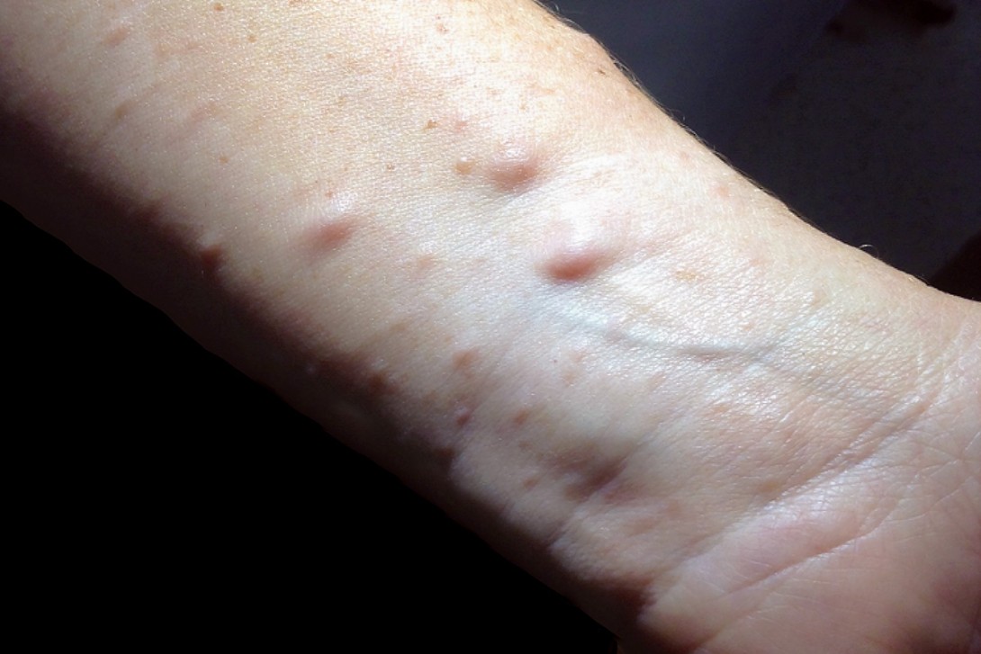Subcutaneous Skin Nodules