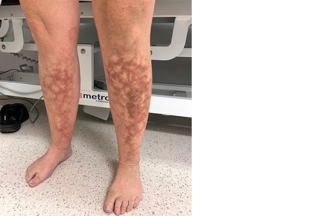 Reticulated hyperpigmentation and erythema on the legs | Medicine Today
