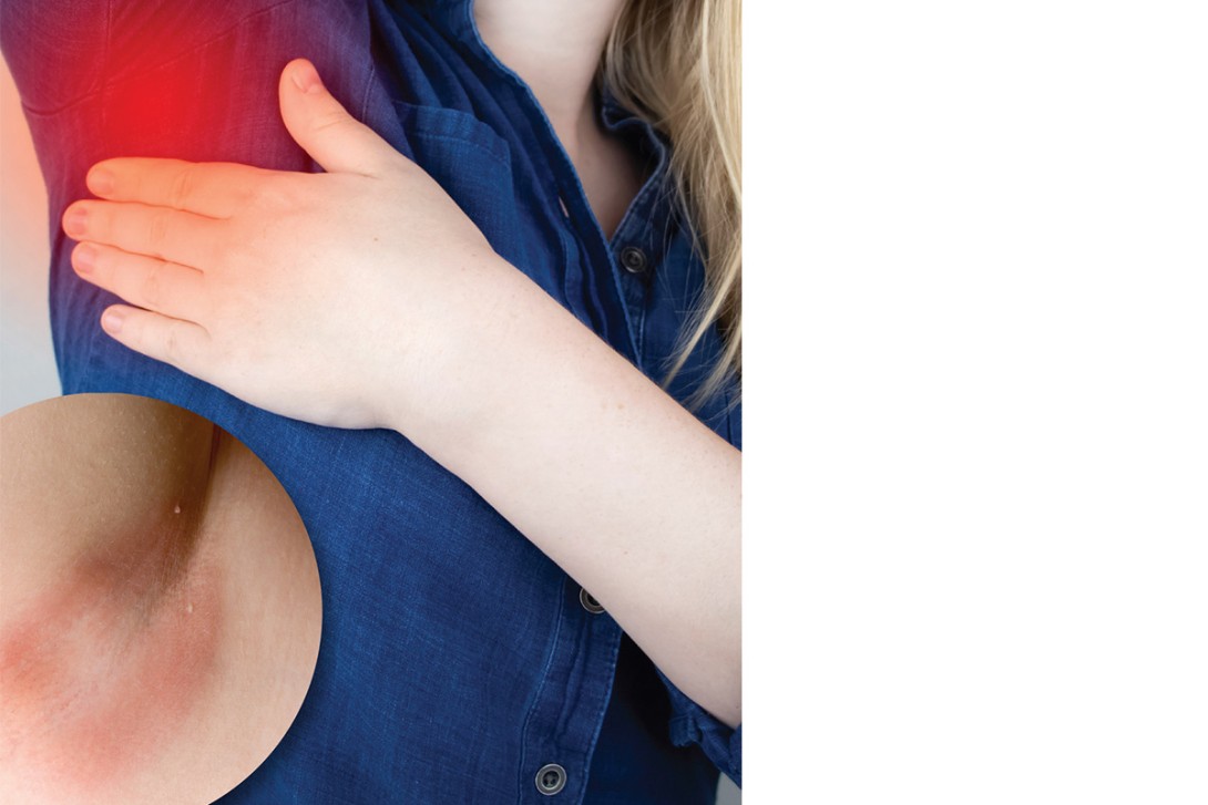Intertriginous skin disorders: what’s lurking where? | Medicine Today