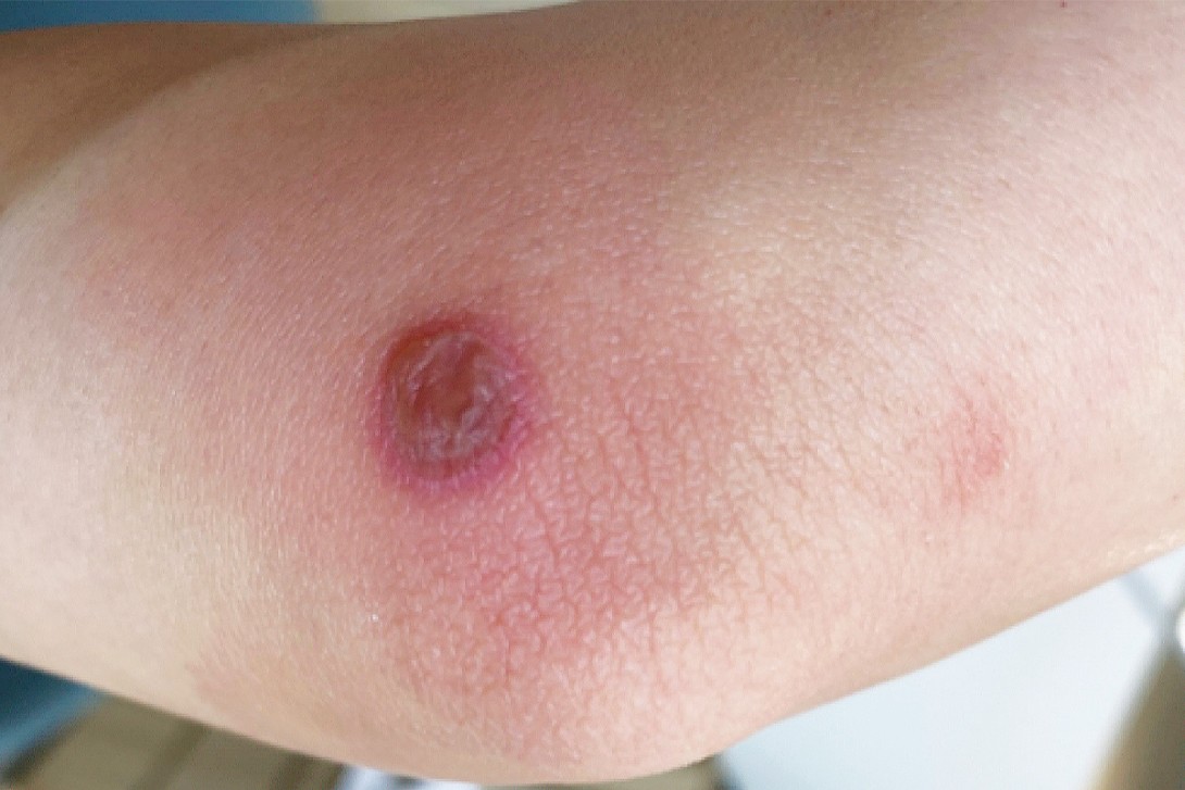 A woman with a recurring blister on her elbow | Medicine Today